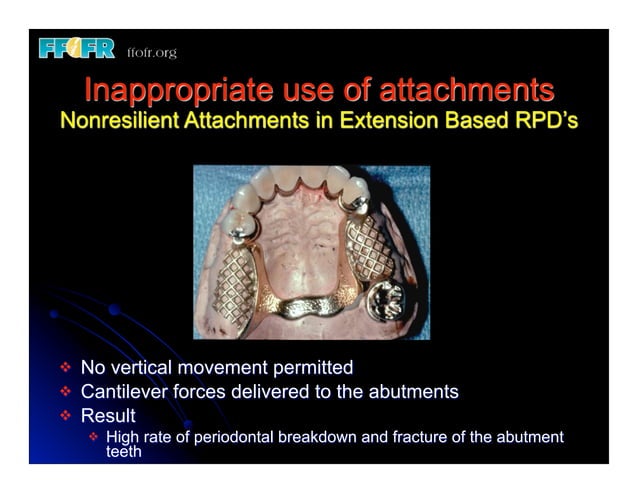 (Replace) 11.esthetics, rotational path, attachments | PPT