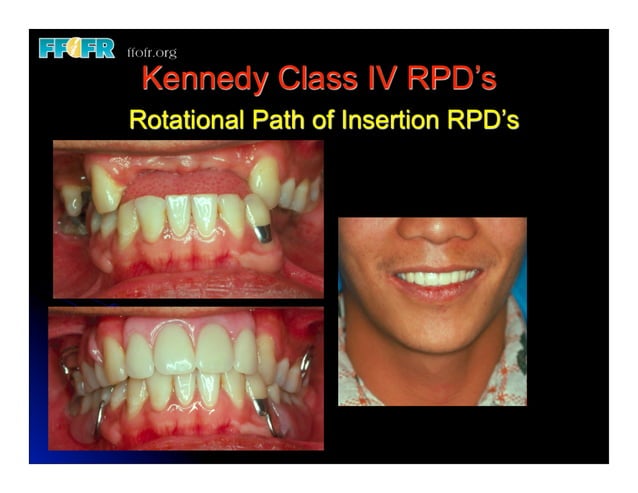 (Replace) 11.esthetics, rotational path, attachments | PPT