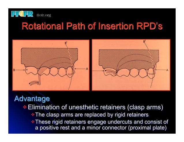 (Replace) 11.esthetics, rotational path, attachments | PPT
