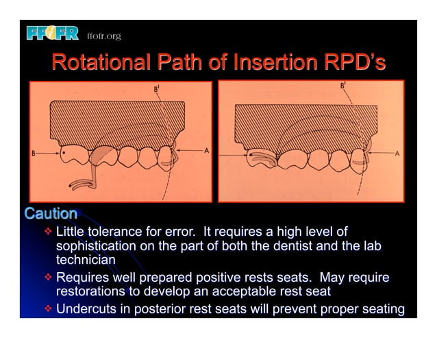 (Replace) 11.esthetics, rotational path, attachments | PPT