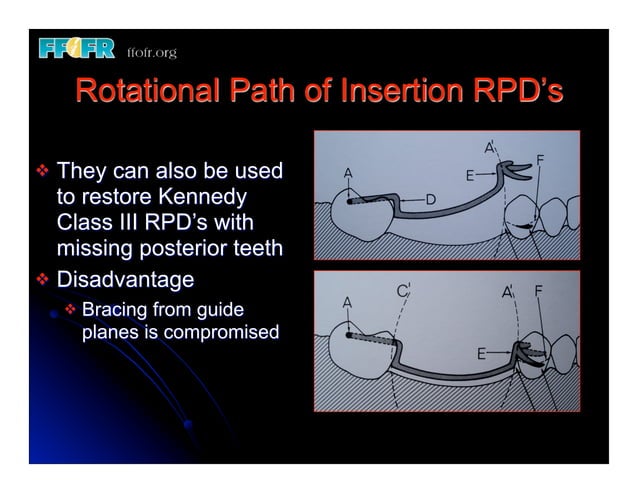(Replace) 11.esthetics, rotational path, attachments | PPT