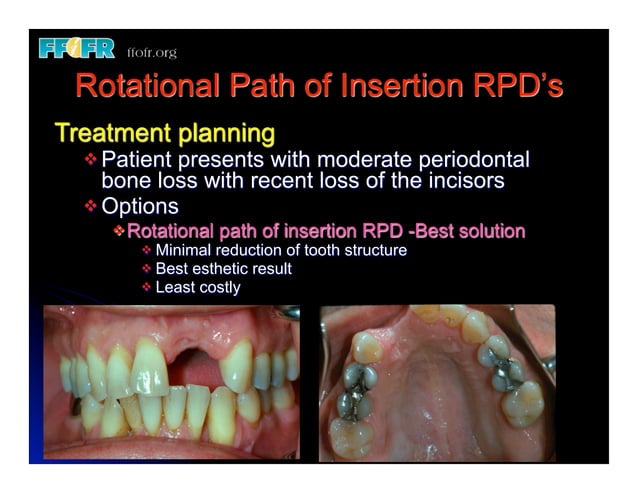 (Replace) 11.esthetics, rotational path, attachments | PPT