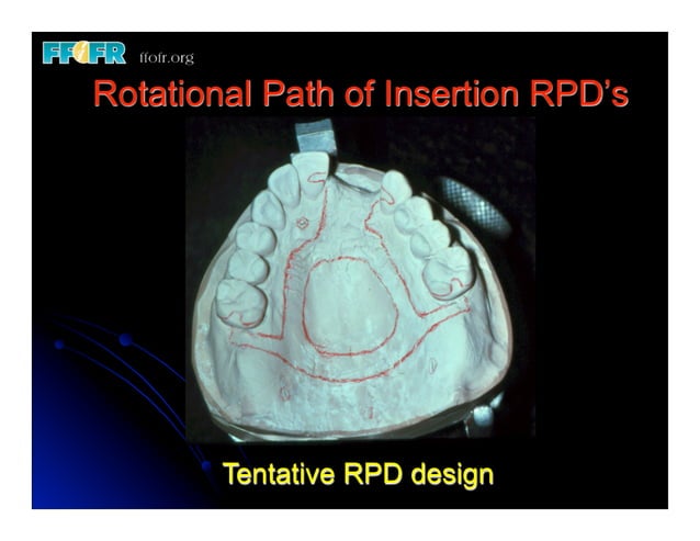 (Replace) 11.esthetics, rotational path, attachments | PPT