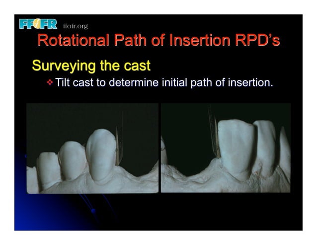 (Replace) 11.esthetics, rotational path, attachments | PPT