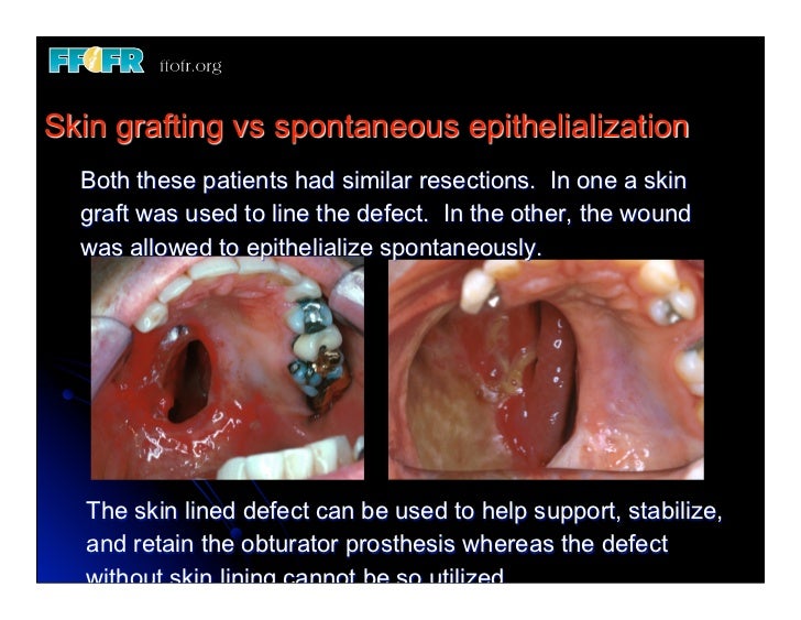 Epithelialization Skin