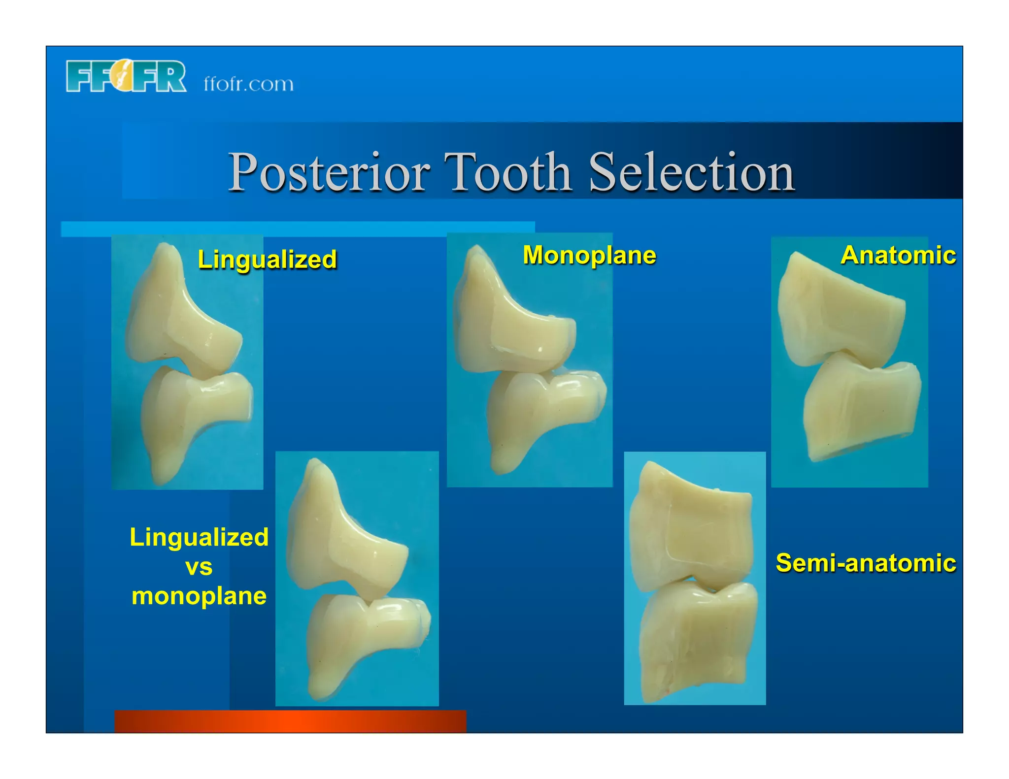 (Replace) 22.criteria for posterior tooth selection | PDF