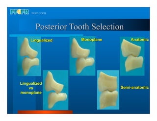 (Replace) 22.criteria for posterior tooth selection | PPT