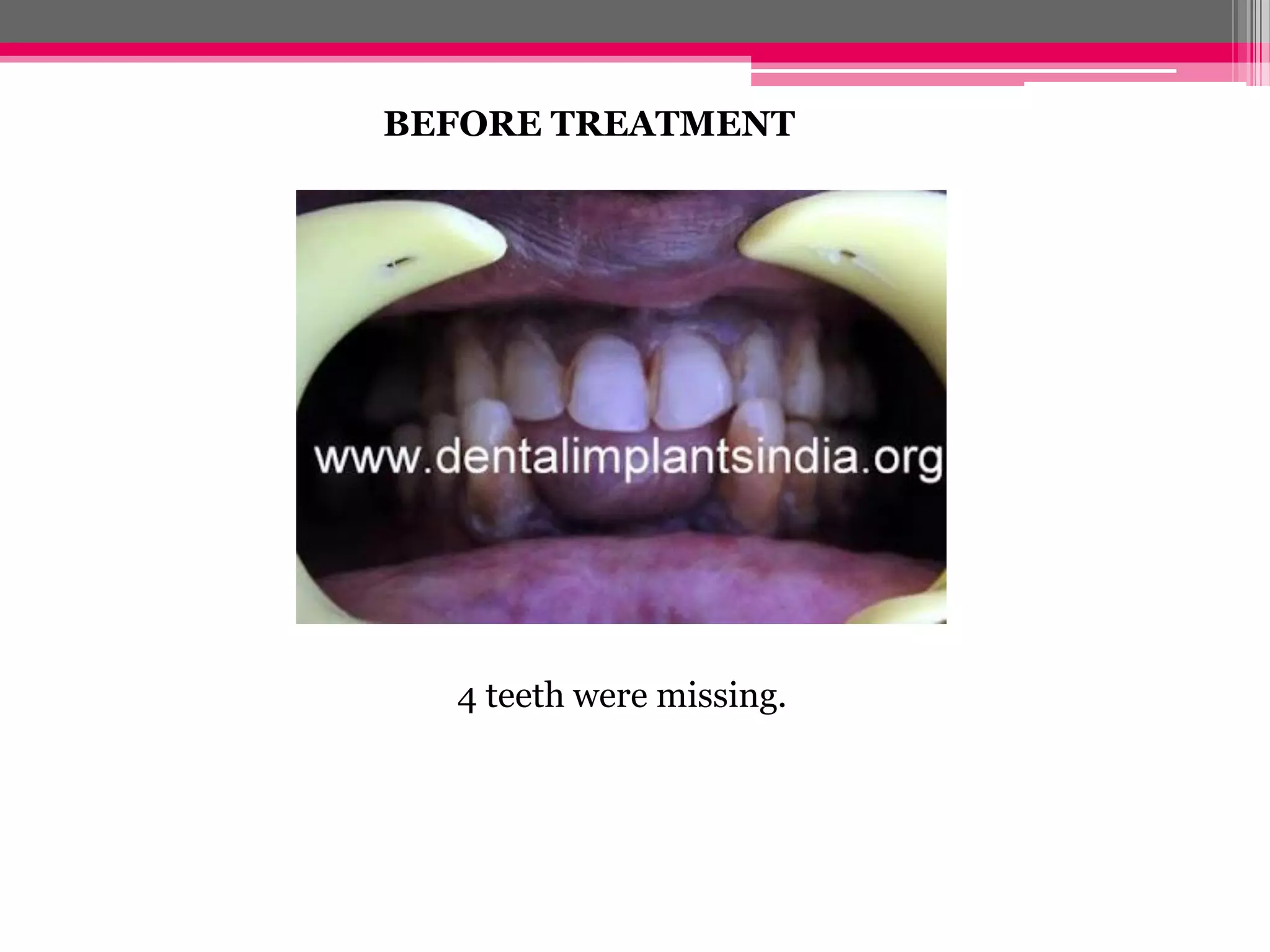 Replacement of missing lower front teeth with basal implant a case ...