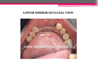 Replacement of missing lower front teeth with basal implant a case ...