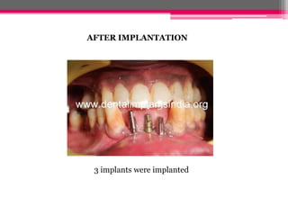 Replacement of missing lower front teeth with basal implant a case ...