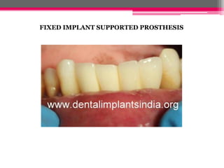 Replacement of missing lower front teeth with basal implant a case ...