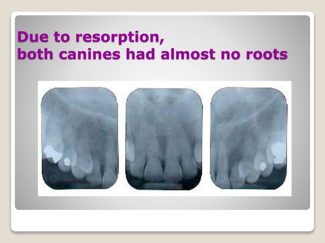 Replacing over retained baby teeth with mini dental implants | PPTX