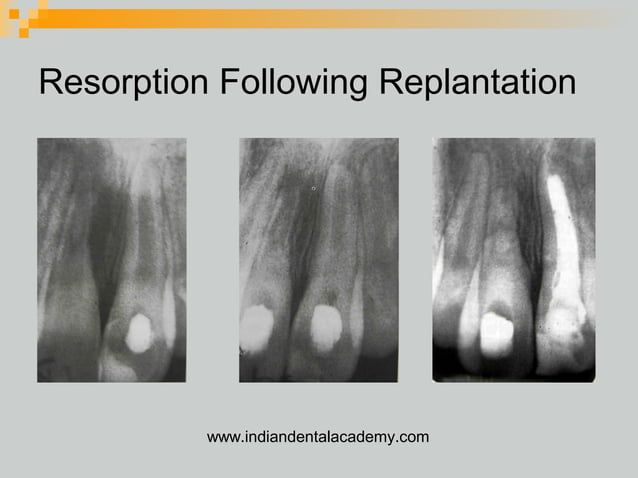 Replantation in dentistry / /certified fixed orthodontic courses by ...