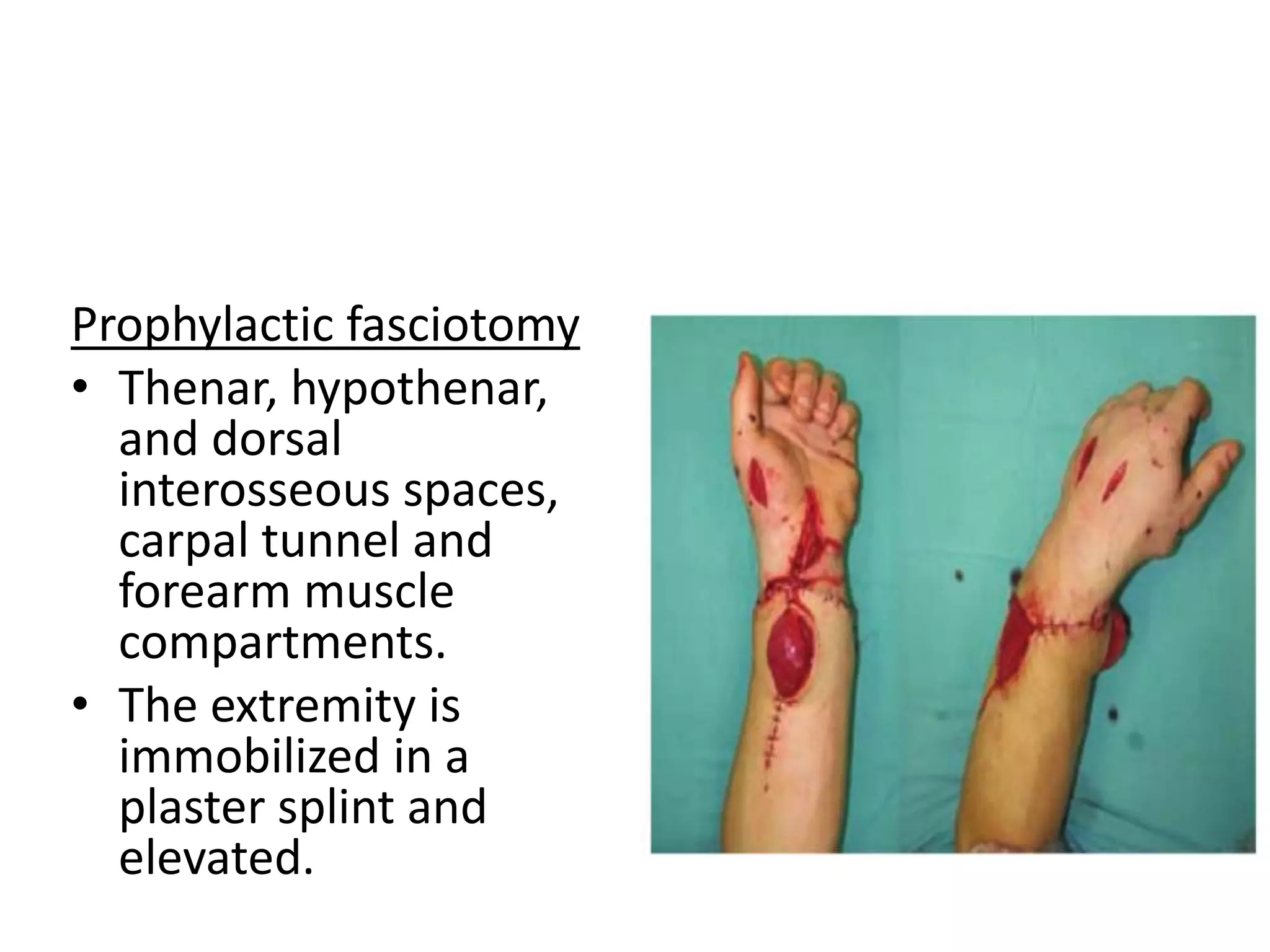 Replantation of the hand and Upper extremity | PPT