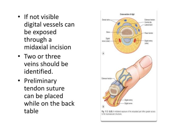 Replantation of the hand and Upper extremity | PPT | First Aid | Injuries