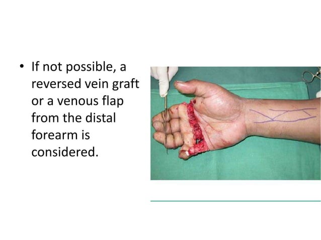 Replantation of the hand and Upper extremity | PPT | First Aid | Injuries