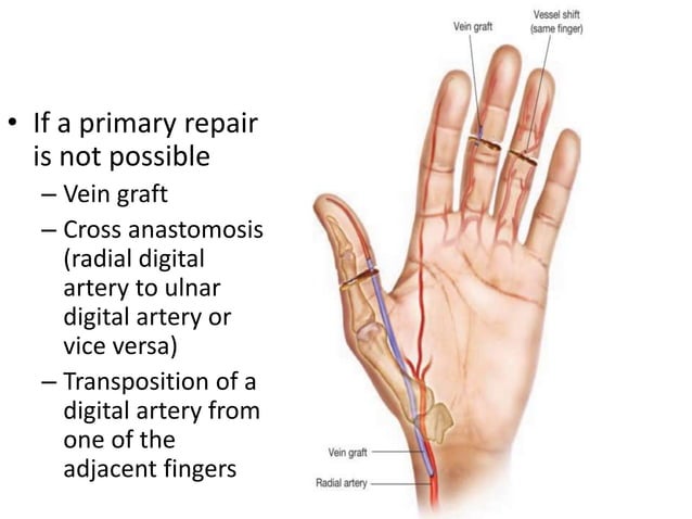 Replantation of the hand and Upper extremity | PPT | First Aid | Injuries