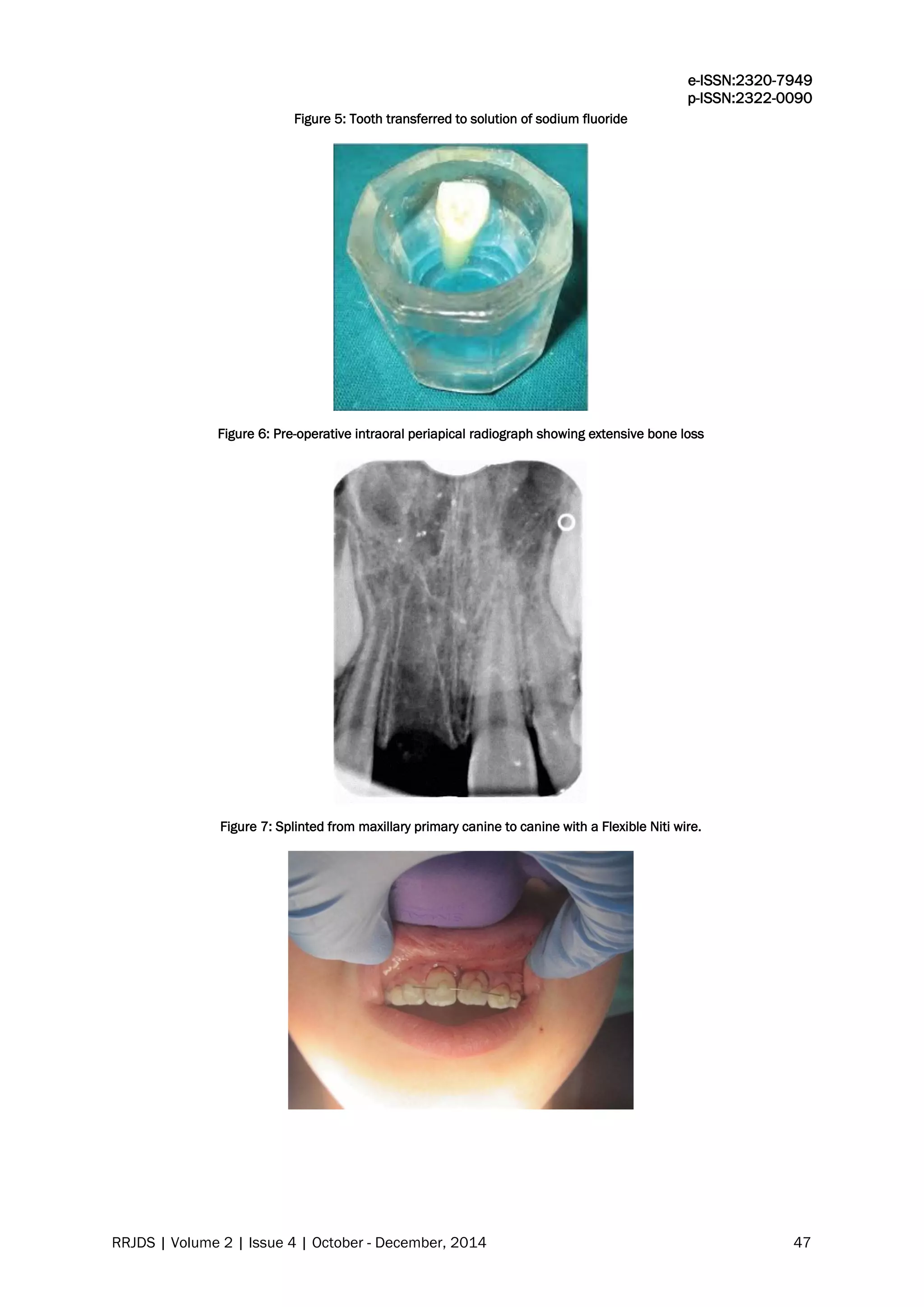 Replantation of-avulsed-permanent-anterior-teeth-a-case-report-43-52(1 ...