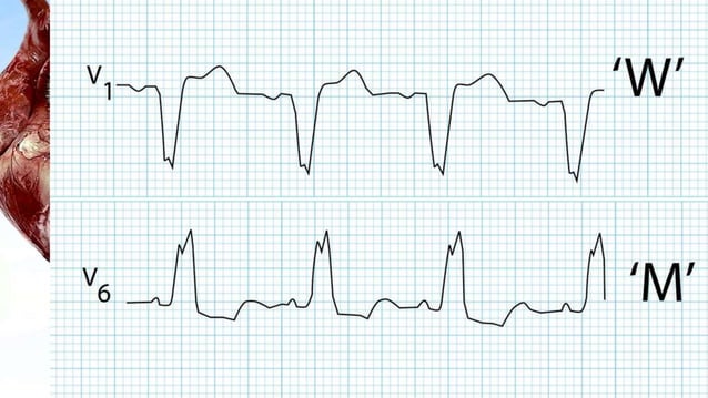 Repolarization ST wave Abnormalities | PPTX