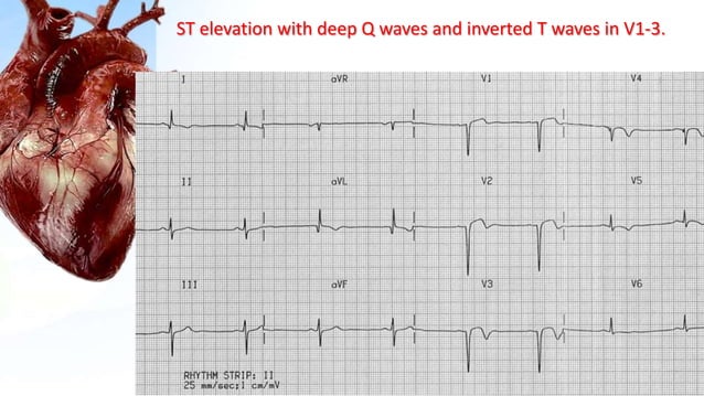 Repolarization ST wave Abnormalities | PPTX