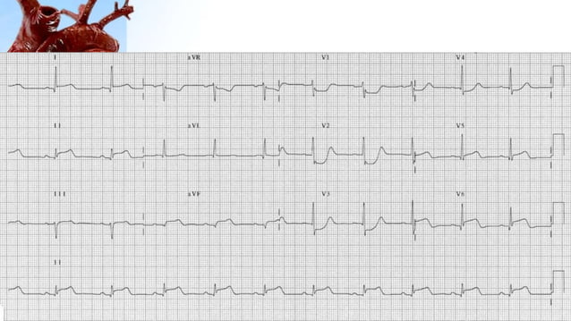 Repolarization ST wave Abnormalities | PPTX