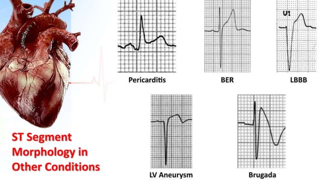 Repolarization ST wave Abnormalities | PPTX
