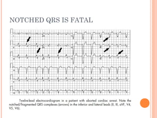 Repolarization syndromes | PPT