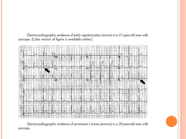 Repolarization syndromes