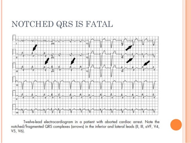 Repolarization syndromes