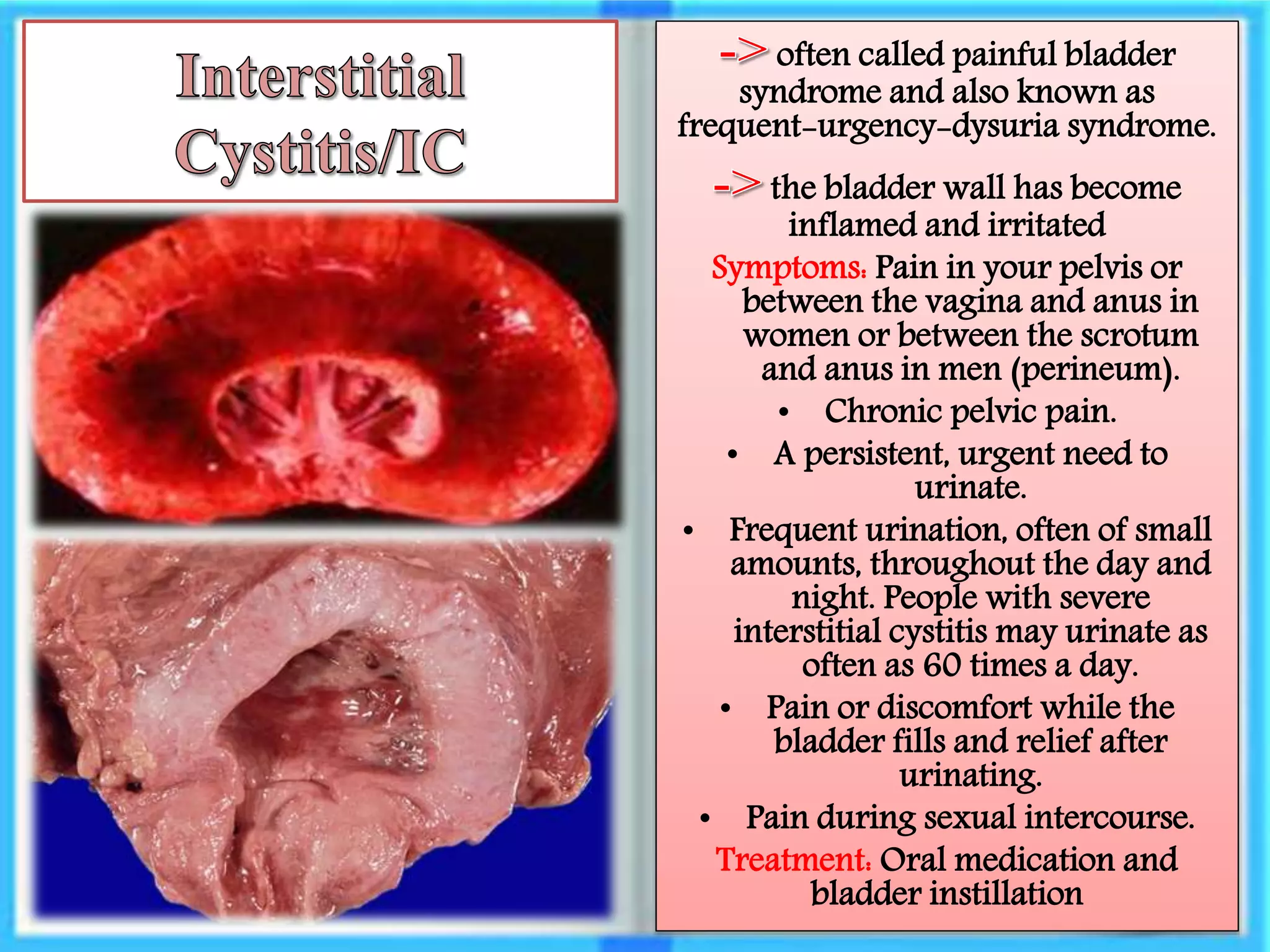 Urinary Diseases | PPTX