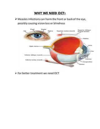 Report on EYE-OCT.(OPTICAL COHERANCE TOMOGRAPHY) | DOCX