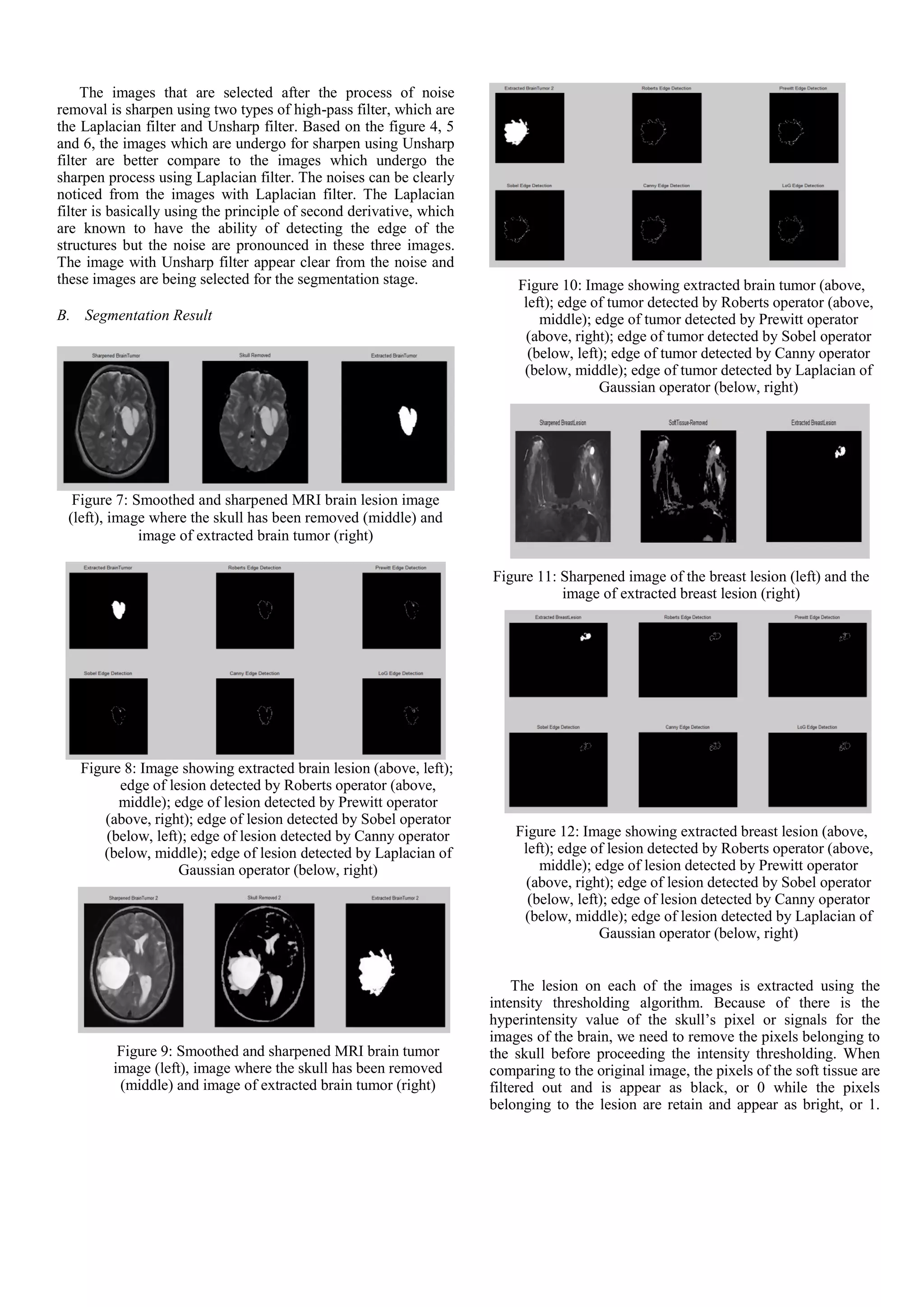 Empirical Edge Detection And Extraction Of Lesion Using Image Processing Technique Pdf