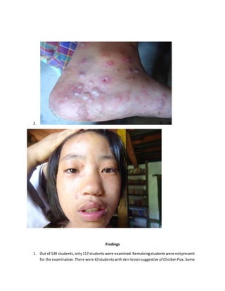 Report on skin disease outbreak at shingkhar primary school | DOCX