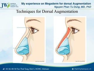 My experience on Megaderm for dorsal Augmentation | PPT