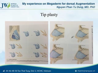 My experience on Megaderm for dorsal Augmentation | PPT
