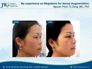 My experience on Megaderm for dorsal Augmentation | PPT