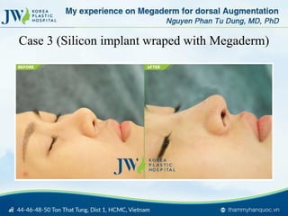 My experience on Megaderm for dorsal Augmentation | PPT