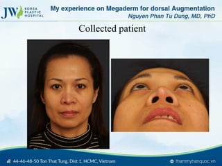 My experience on Megaderm for dorsal Augmentation | PPT