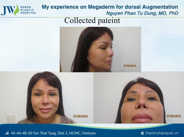 My experience on Megaderm for dorsal Augmentation | PPT