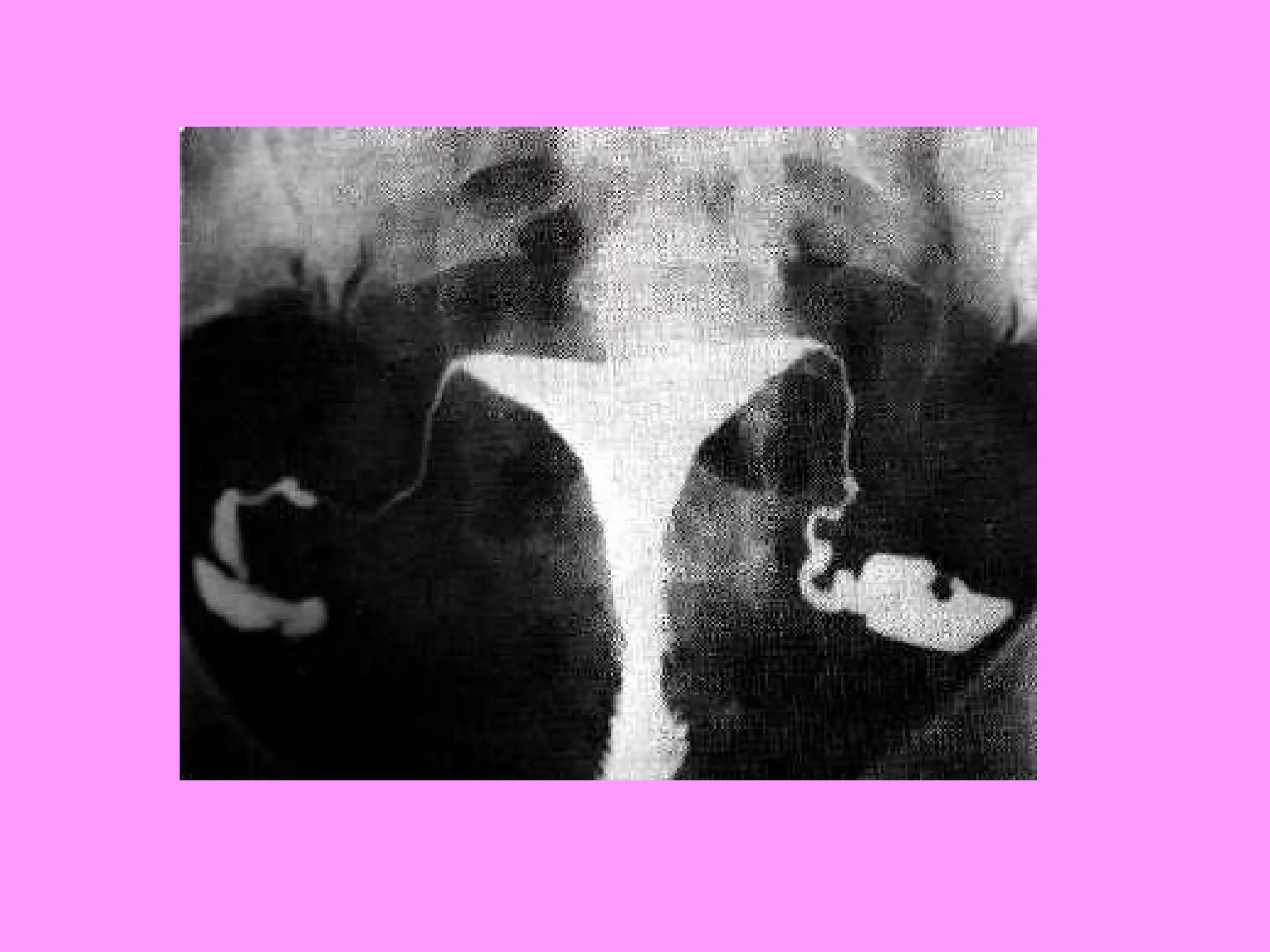 Reproductive System Disorders | PPT