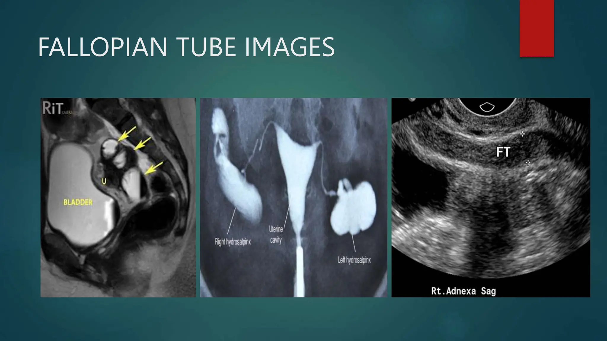 REPRODUCTIVE SYSTEM PPT.pptx radiographic | PPTX