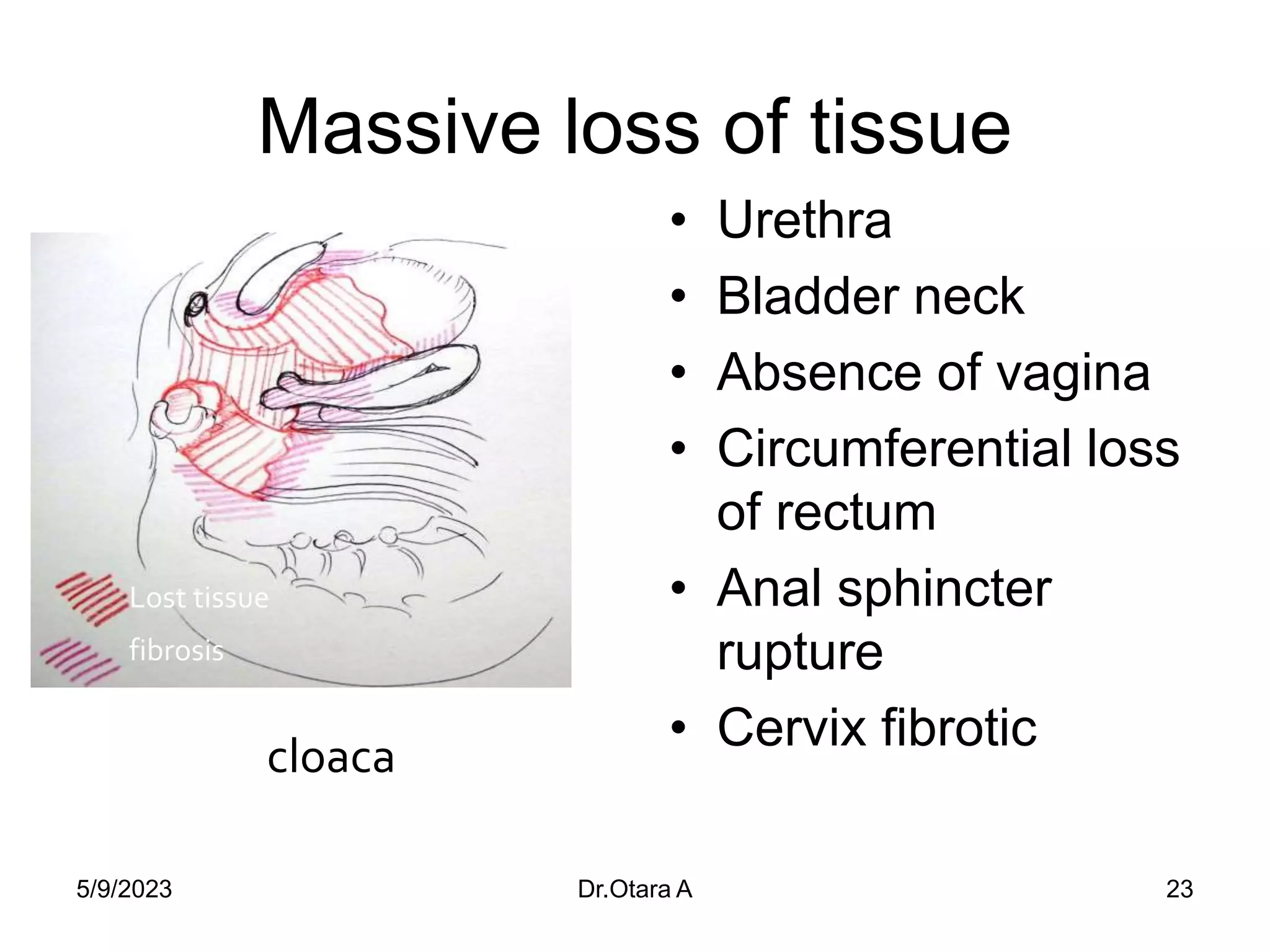 Reproductve tract Fistulae.ppt