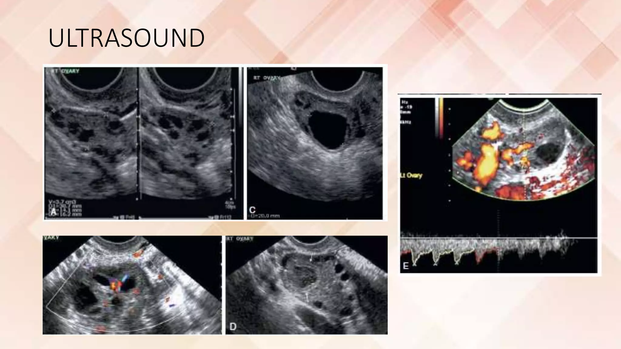 Imaging of female reproductive system RV | PPTX