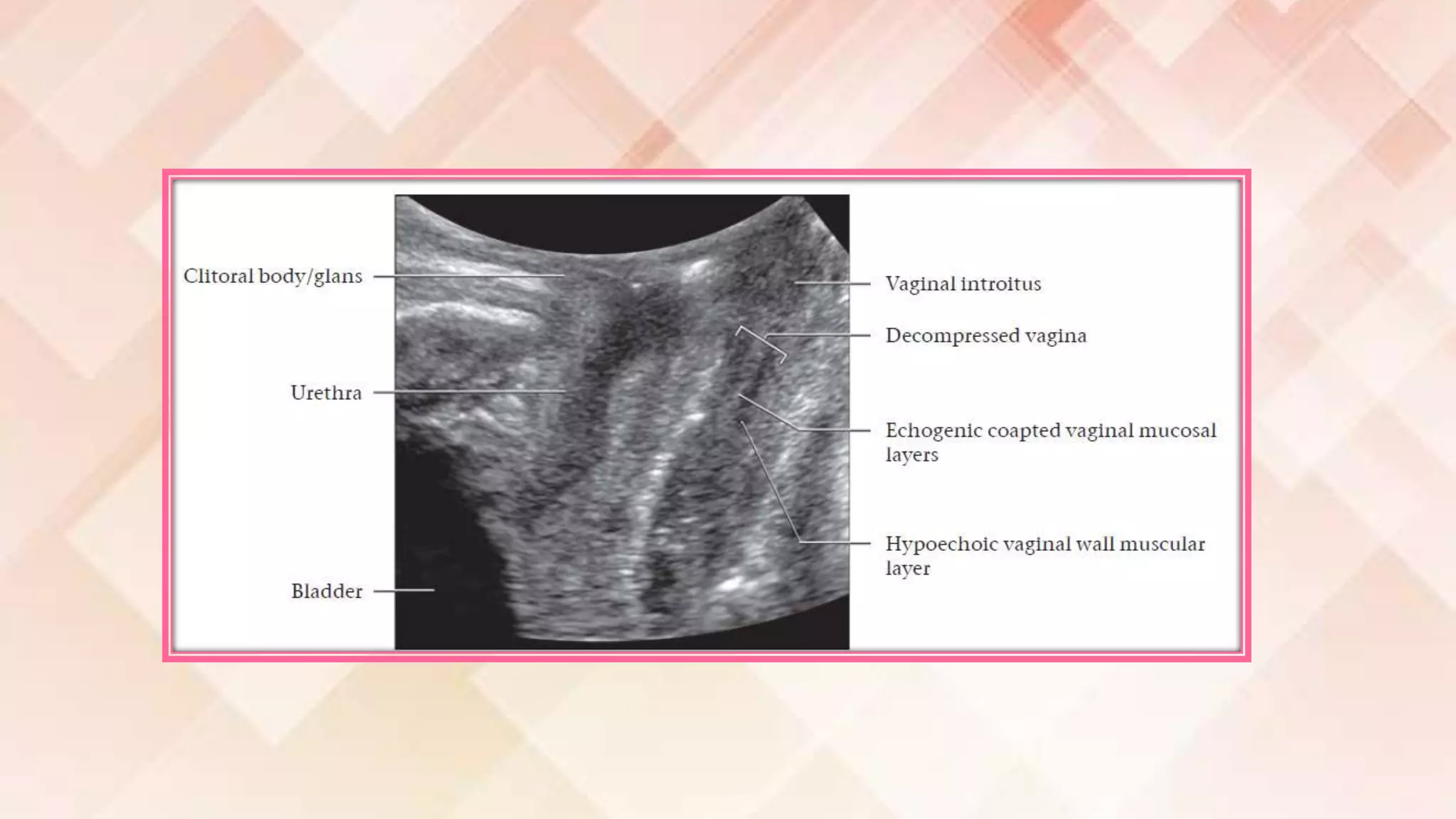 Imaging of female reproductive system RV | PPTX