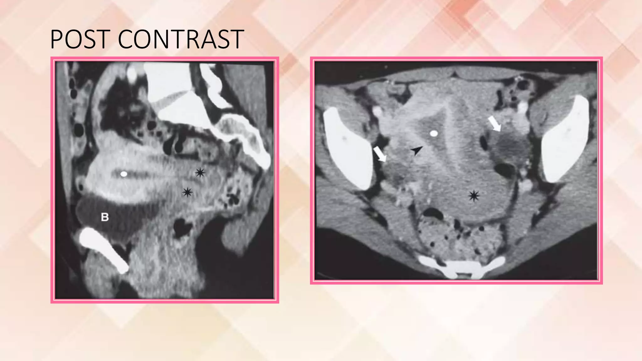 Imaging of female reproductive system RV | PPTX