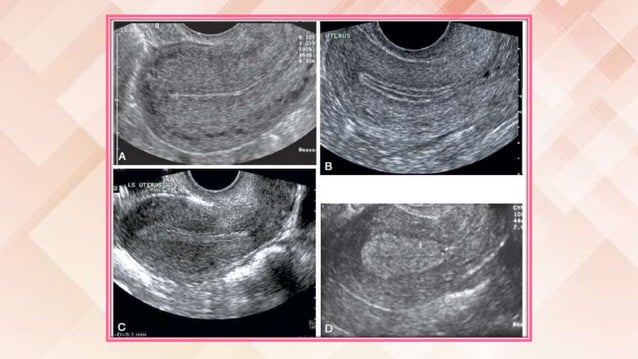 Imaging of female reproductive system RV | PPTX