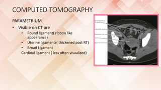 Imaging of female reproductive system RV | PPTX