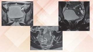 Imaging of female reproductive system RV | PPTX