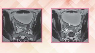 Imaging of female reproductive system RV | PPTX