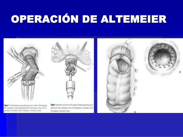 PROLAPSO RECTAL: DIAGNOSTICO Y MANEJO